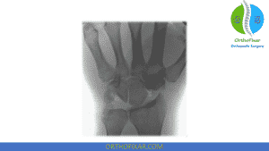 SNAC And SLAC Of The Wrist | OrthoFixar