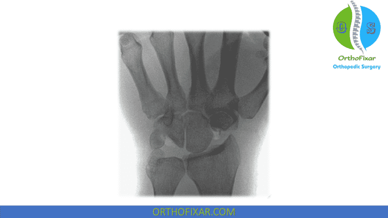 SNAC And SLAC Of The Wrist | OrthoFixar