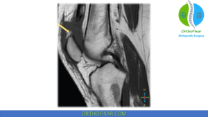 Quadriceps Tendon Rupture: Causes, Diagnosis & Treatment