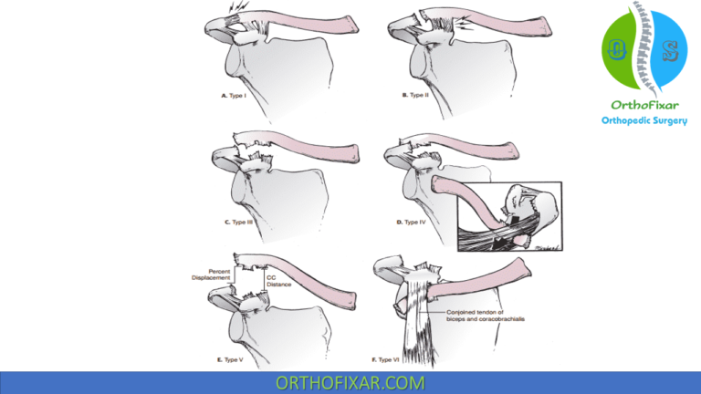 AC Joint Separation - Easy Explained | OrthoFixar 2025
