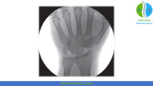 Proximal Row Carpectomy
