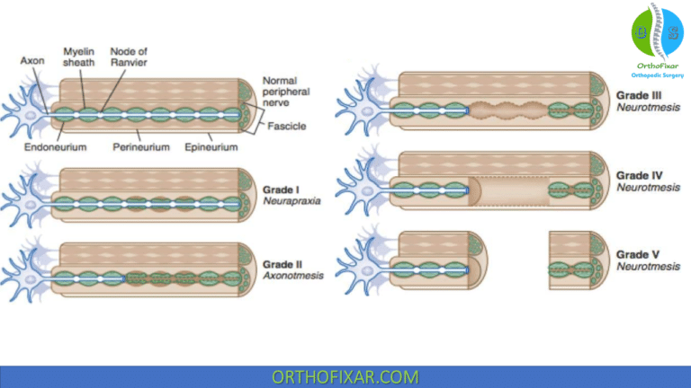 Classification Of Nerve Injuries | OrthoFixar 2025