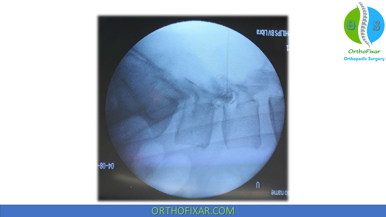 Nerve Root Injection - Full Review | OrthoFixar 2025