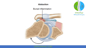 Subacromial Impingement Syndrome | OrthoFixar
