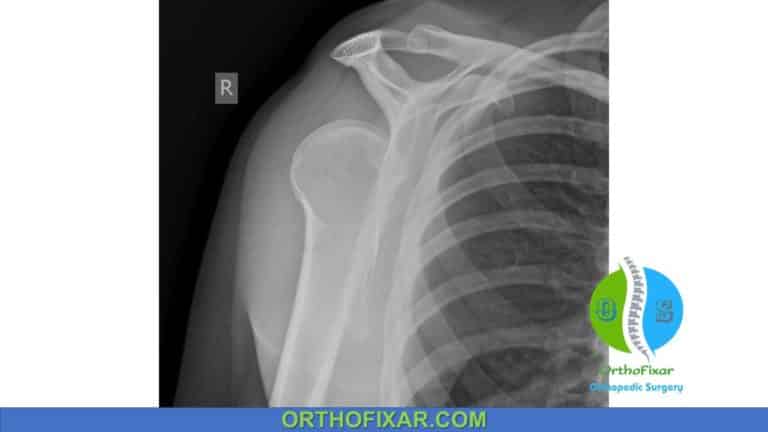 Shoulder Posterior Stress Test • 2025 | OrthoFixar