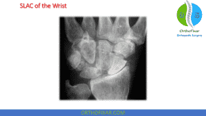 SNAC And SLAC Of The Wrist | OrthoFixar