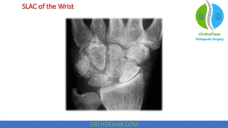 SNAC And SLAC Of The Wrist | OrthoFixar