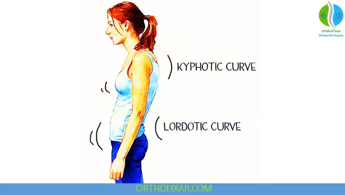 Swayback Deformity | Orthopedic Learning