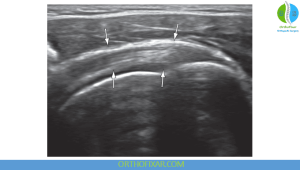 Shoulder Ultrasound Radiology | OrthoFixar