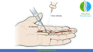 Trigger Finger | Stenosing Tenosynovitis | OrthoFixar