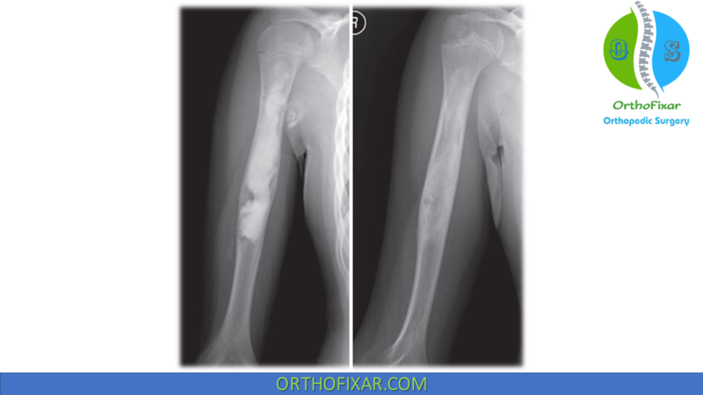 Unicameral Bone Cyst | OrthoFixar 2023