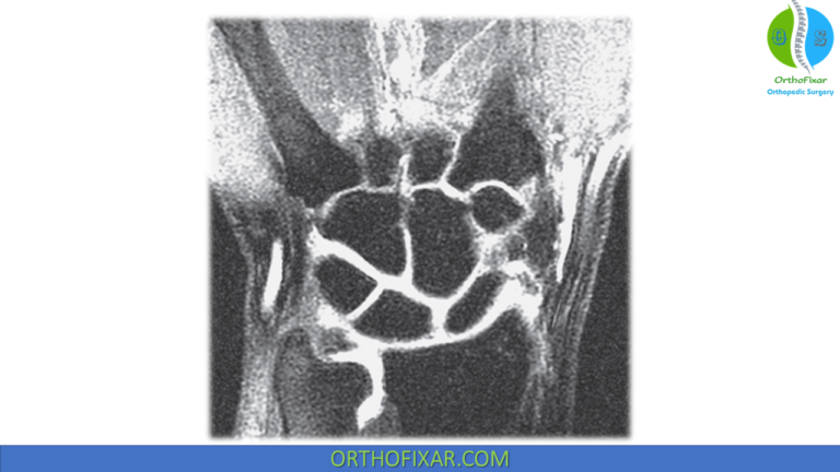 Triangular Fibrocartilage Complex Injury & Treatment | 2025