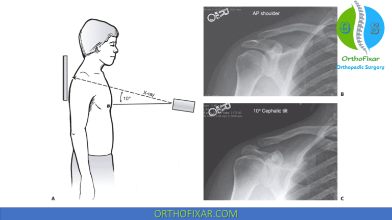 AC Joint Separation - Easy Explained | OrthoFixar 2026