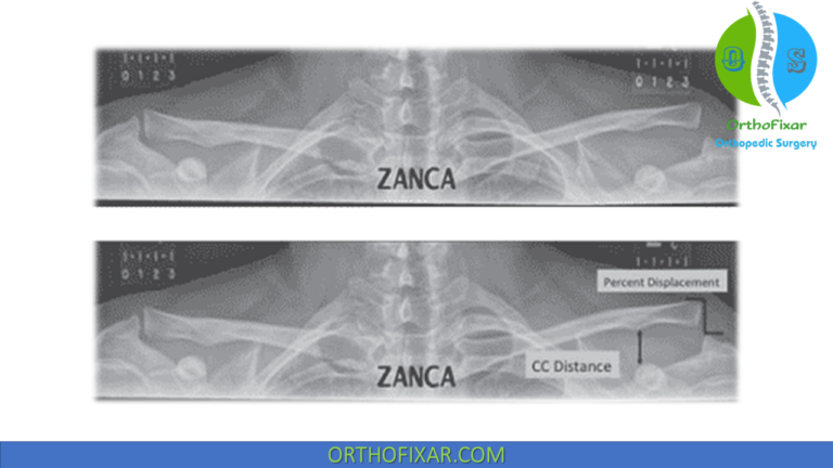 AC Joint Separation - Easy Explained | OrthoFixar 2026